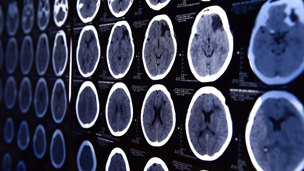 New Research Links Pre-Trauma Amygdala Activity to Later PTSD Symptoms
